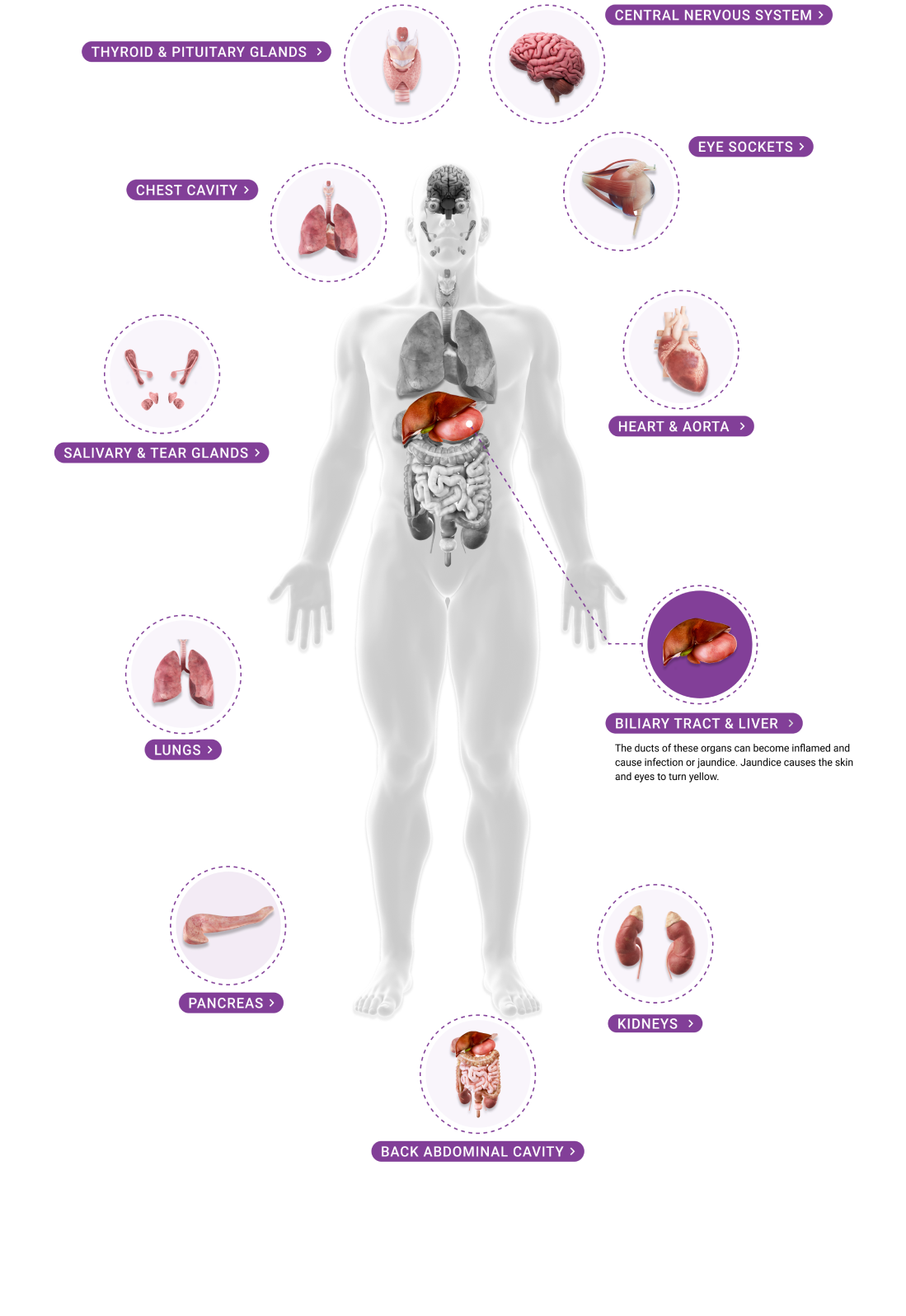 IgG4-RD Symptom Visualization Tool | UPLIZNA® (inebilizumab-cdon)