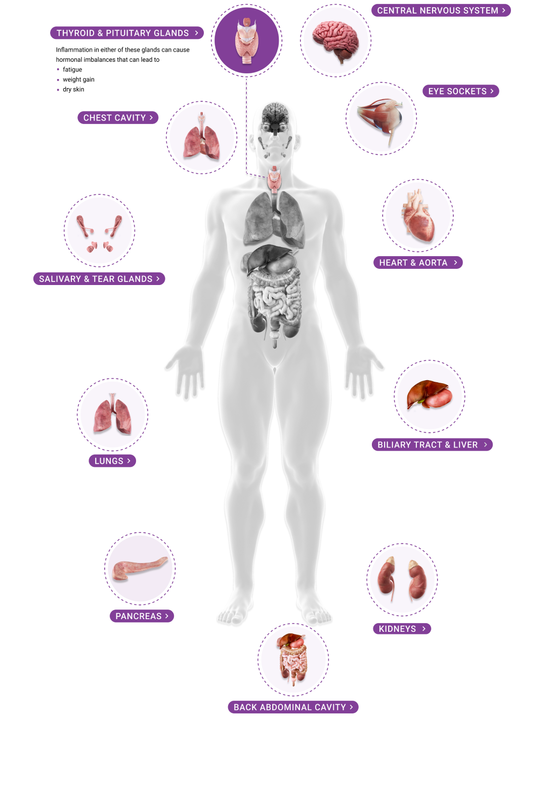 IgG4-RD Symptom Visualization Tool | UPLIZNA® (inebilizumab-cdon)